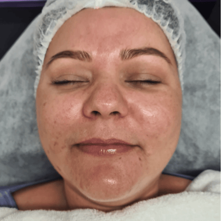 Dermaplaning | Epi-blading | National Skin Cancer Centres